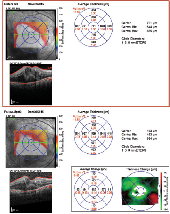 Pharmacologic Treatment of PDR and DME - Retina Today