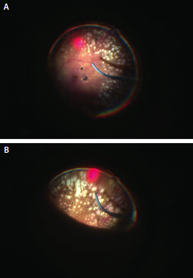 Laser Probes and Valved Cannulas Can Help Maximize Surgical Efficiency ...