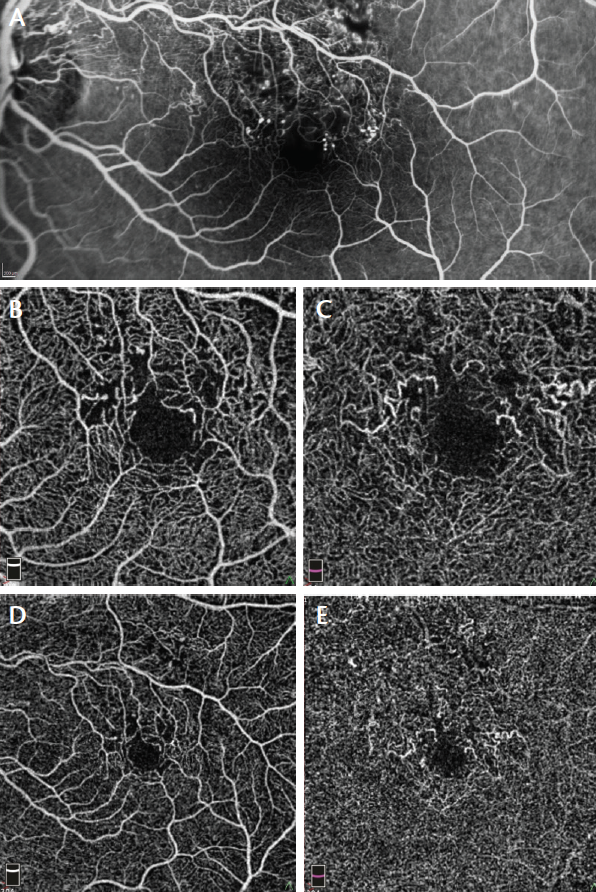 Angiography Version 2.0 - Retina Today