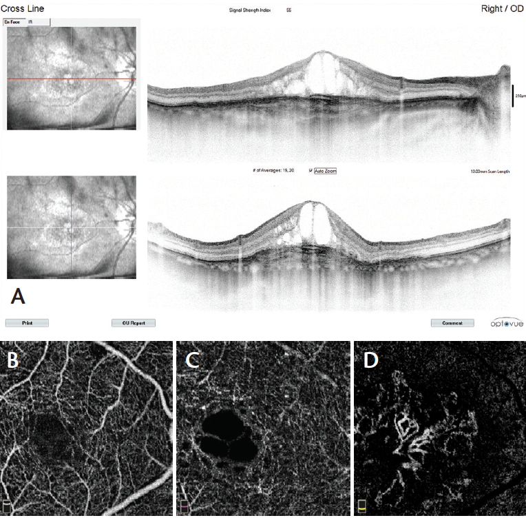 Angiography Version 2.0 - Retina Today