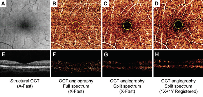 Angiography Version 2.0 - Retina Today