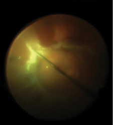 Treating Recurrent Retinal Detachment Due to PVR - Retina Today