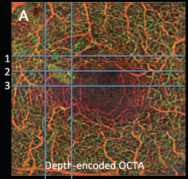 A Role for OCTA in Daily Retina Practice - Retina Today