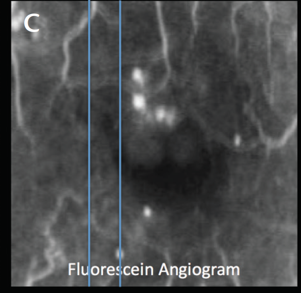 A Role for OCTA in Daily Retina Practice - Retina Today