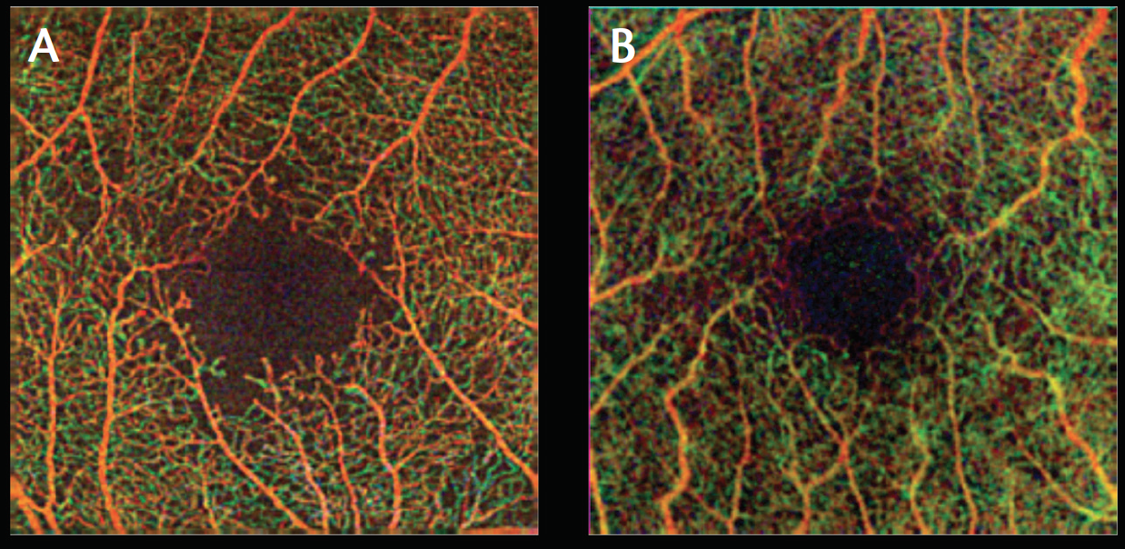 A Role for OCTA in Daily Retina Practice - Retina Today