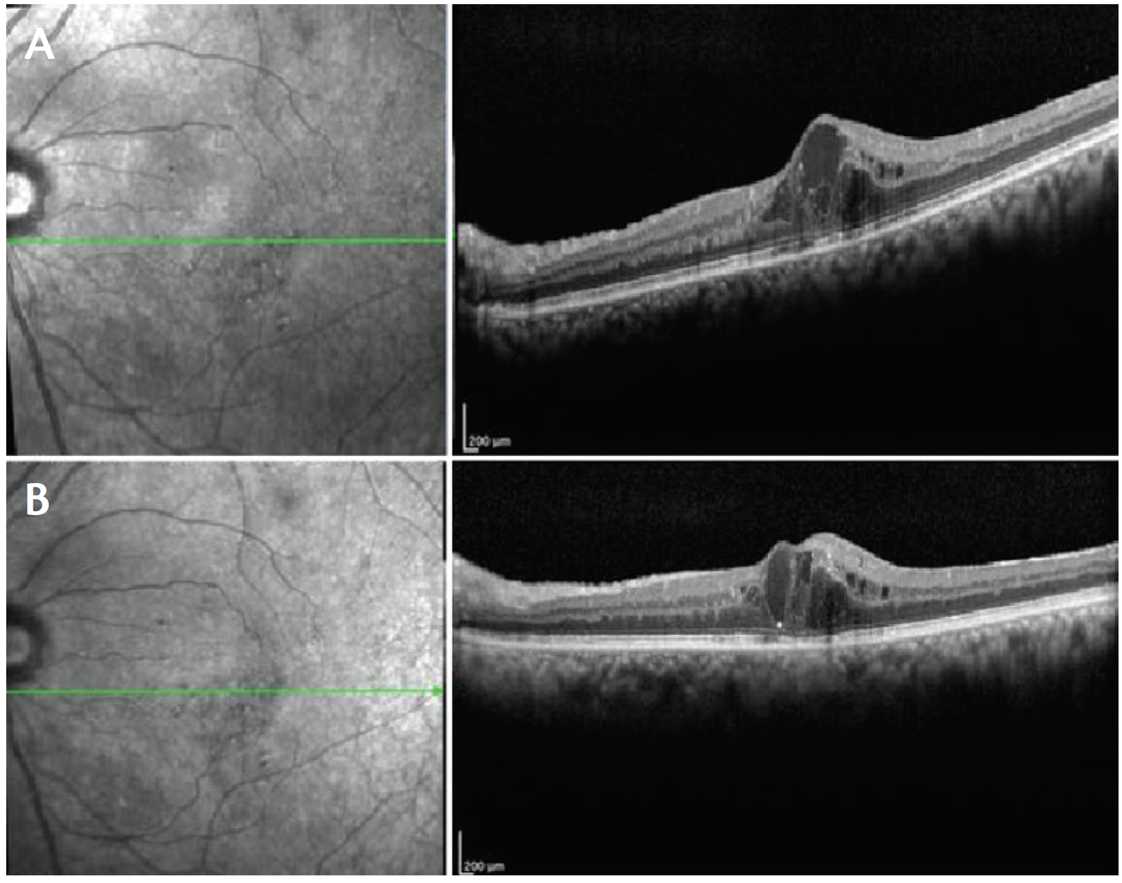 Exploring Two Photocoagulation Modes for DME - Retina Today