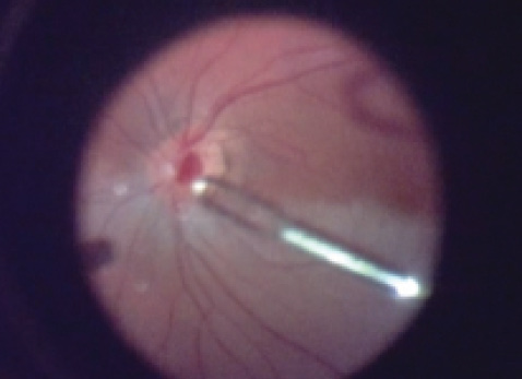 Retinal Embolectomy: Why, When, How? - Retina Today