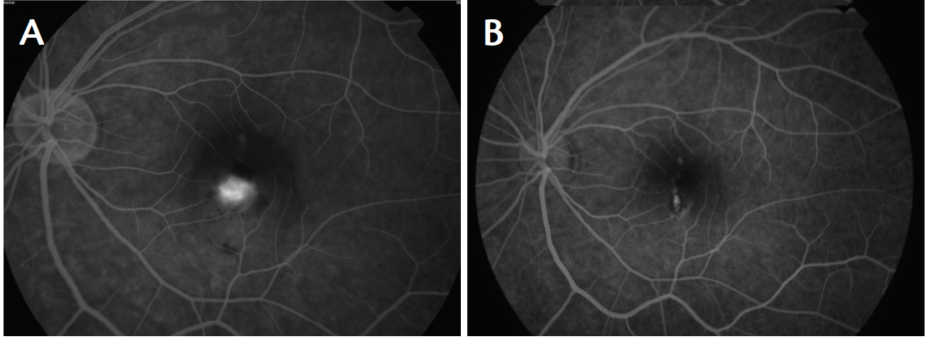 Managing Retinal Detachment After Refractive Surgery - Retina Today
