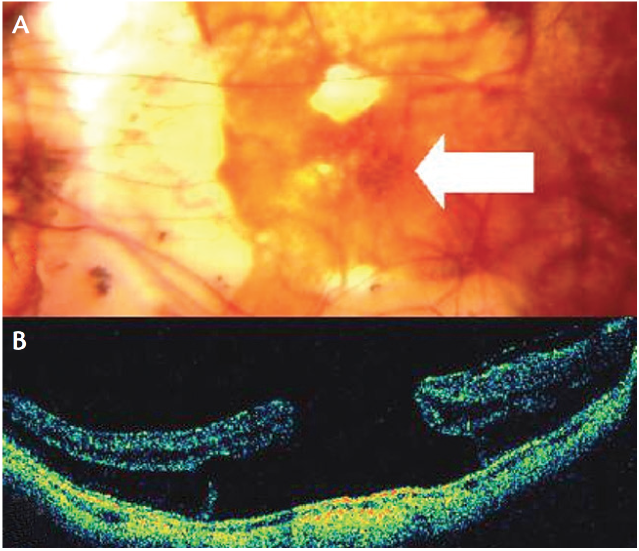 Managing Retinal Detachment After Refractive Surgery - Retina Today