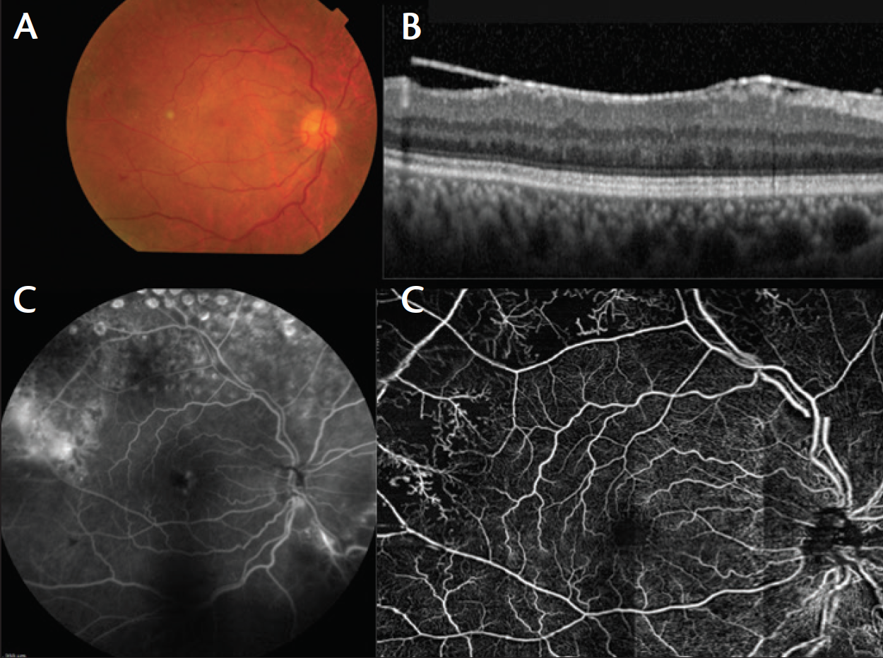 Panoramic Imaging With OCTA - Retina Today