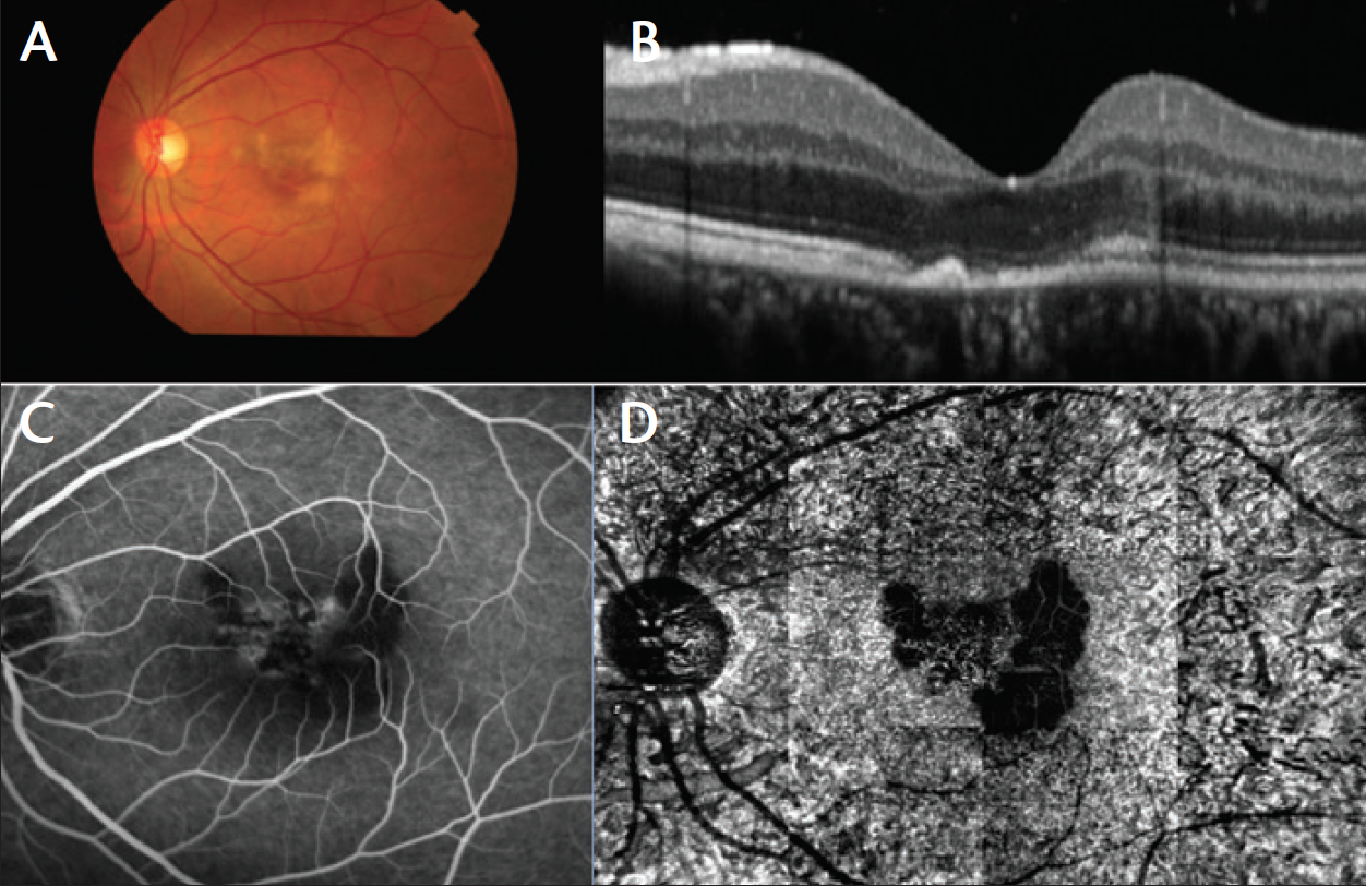 Panoramic Imaging With OCTA - Retina Today