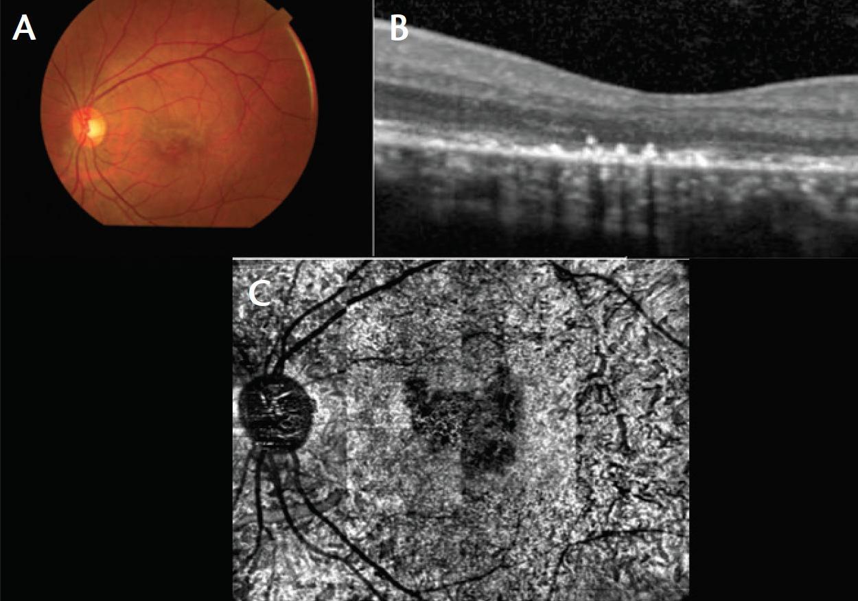 Panoramic Imaging With OCTA - Retina Today