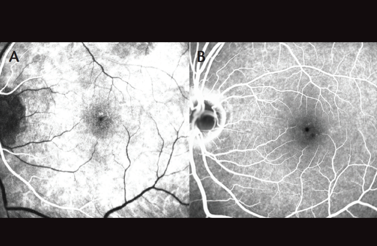 Making a Diagnosis: Unilateral Acute Idiopathic Maculopathy - Retina Today