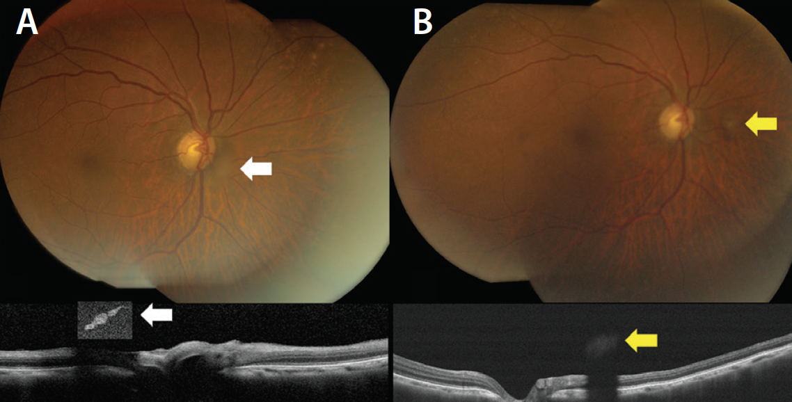 Choroidal 'Ghost' Nevus - Retina Today