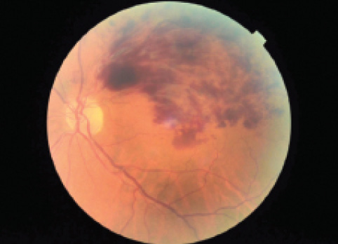 When to Use Steroids for Retinal Vein Occlusion - Retina Today