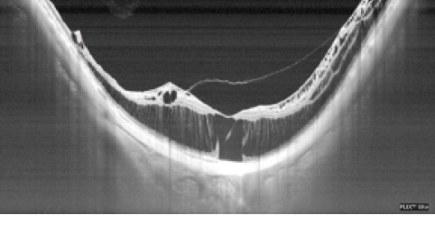 When and How to Treat Myopic Traction Maculopathy - Retina Today