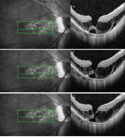 When and How to Treat Myopic Traction Maculopathy - Retina Today