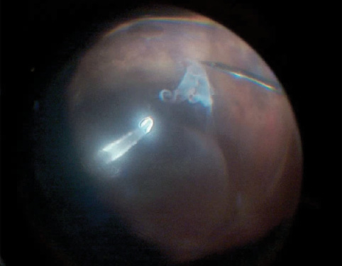 Heads-up 3-D Visualization in Complex Vitreoretinal Surgery - Retina Today