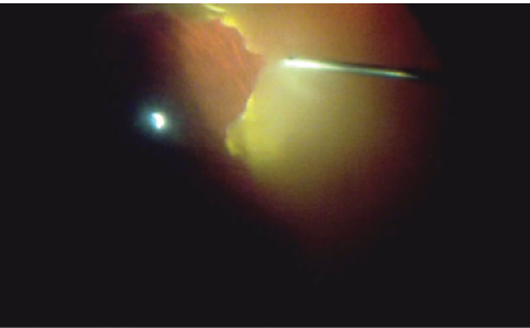 Heads-up 3-D Visualization in Complex Vitreoretinal Surgery - Retina Today
