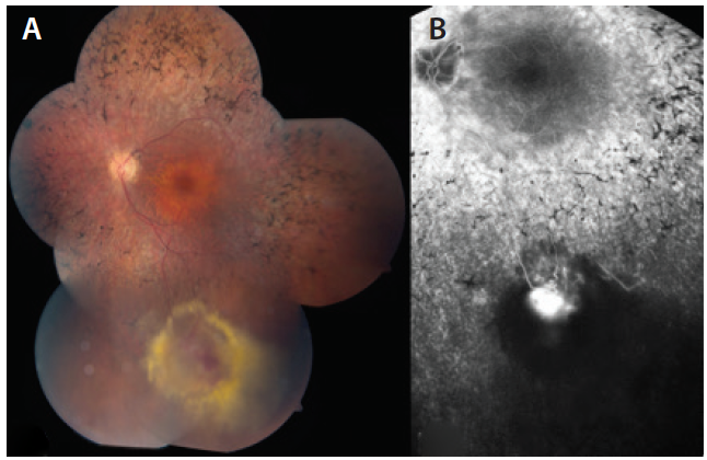 Retinal Vasoproliferative Tumor Secondary to Retinitis Pigmentosa ...