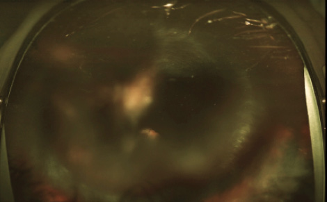 Mastering the Art of Pediatric Retina Examinations - Retina Today