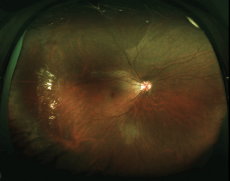 Mastering the Art of Pediatric Retina Examinations - Retina Today