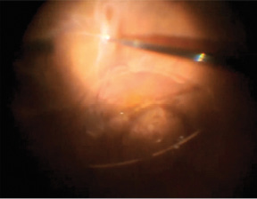 Anterior Proliferative Vitreoretinopathy With Recurrent Retinal ...