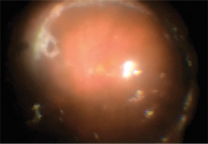 Anterior Proliferative Vitreoretinopathy With Recurrent Retinal ...