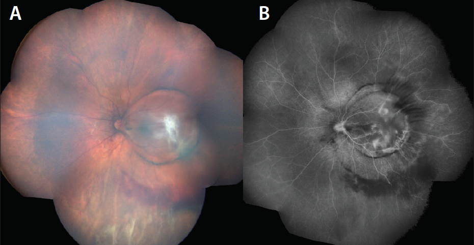 Surgical Repair of Macular Hemorrhage in Child With Terson Syndrome ...