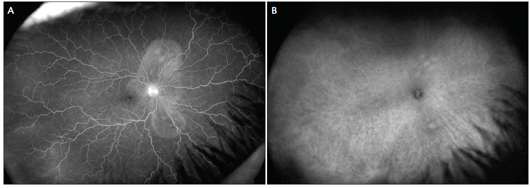 Ultra-Widefield Imaging in the Management of Uveitis - Retina Today