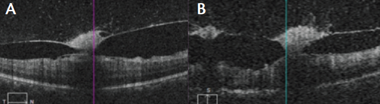 Medicine Plus Surgery Treats an Unusual Case of Fungal Endophthalmitis ...