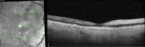 Case Report: Combined Central Retinal Artery and Vein Occlusion After ...