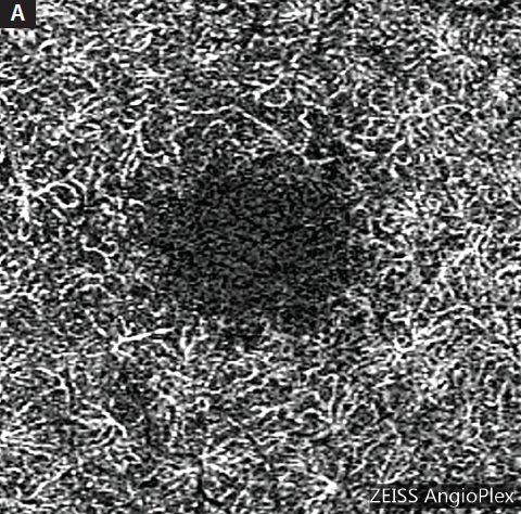 Is OCTA Right for Your Practice? - Retina Today