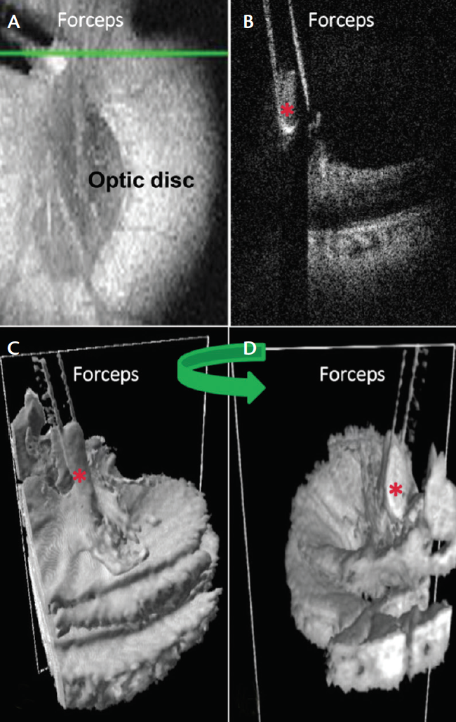 Intraoperative 4-D Microscope-Integrated OCT - Retina Today