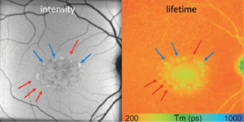 The Lowdown on Fluorescence Lifetime Imaging Ophthalmoscopy - Retina Today