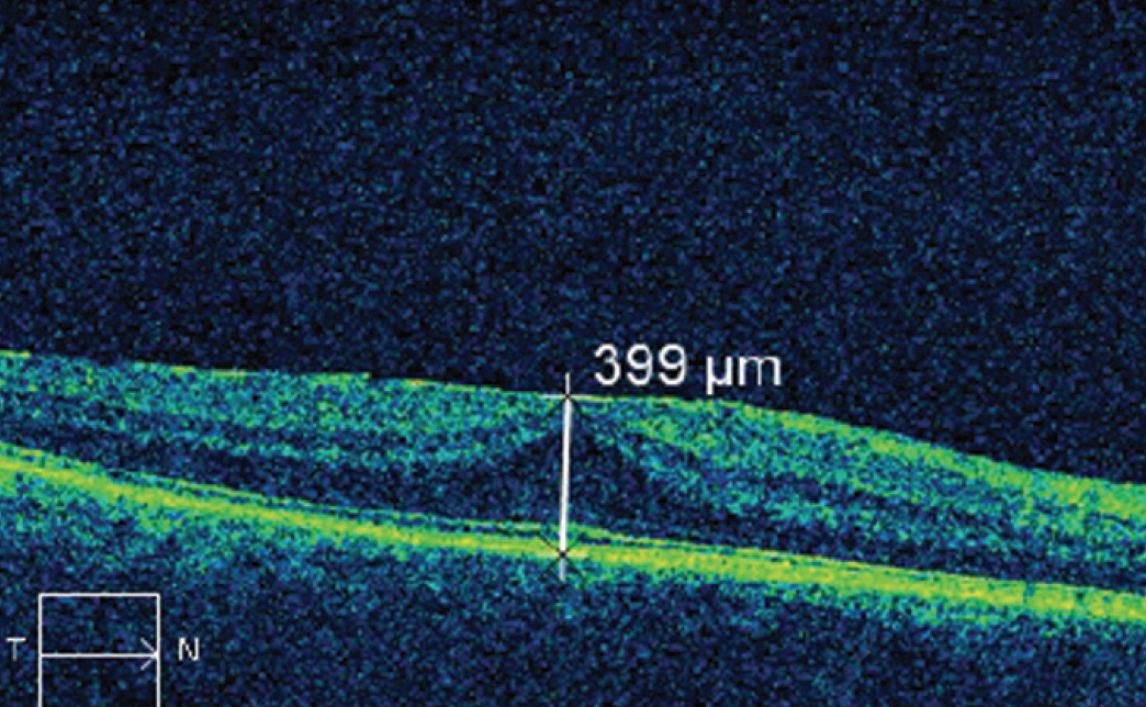 Prophylactic ILM Peeling: When, Why, How? - Retina Today