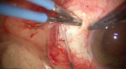 Into the Suprachoroidal Space - Retina Today