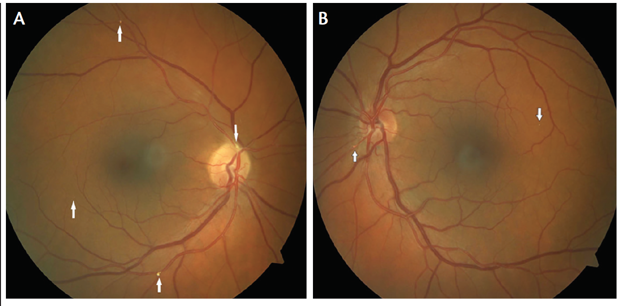 Can't Hear, Can't Think, Can't See. What Can This Be? - Retina Today