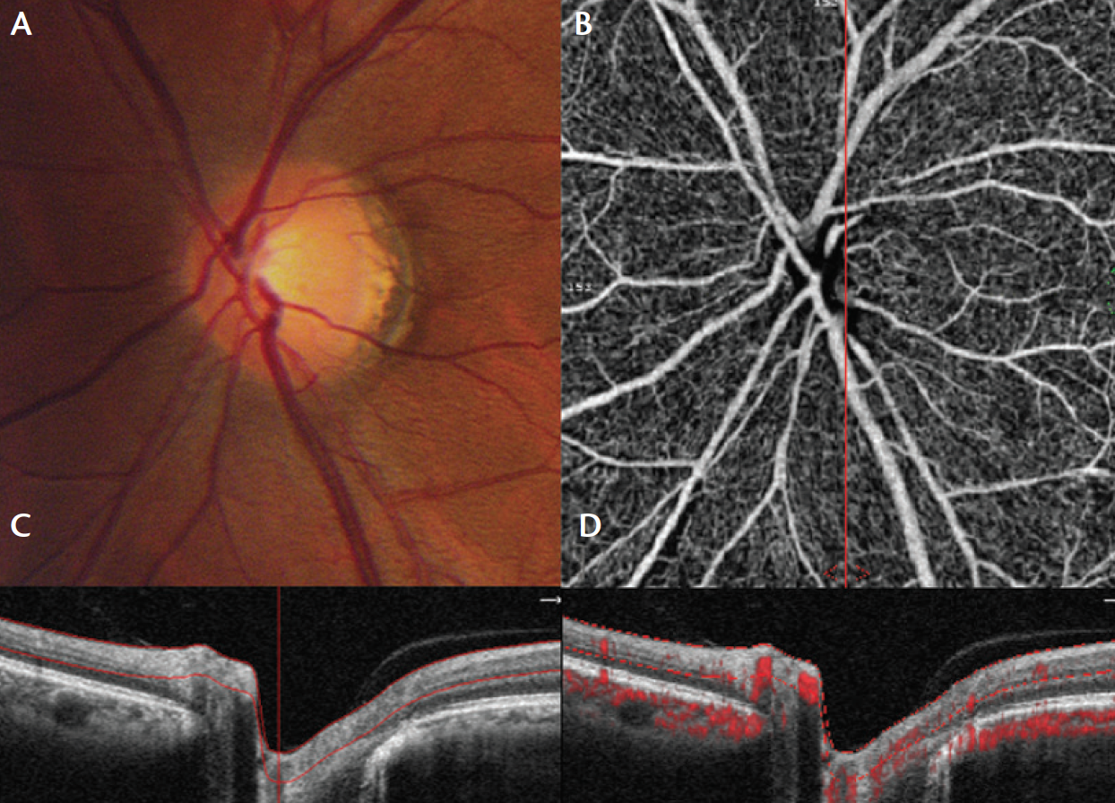 Optic Disc Melanocytoma: Imaging With OCTA - Retina Today
