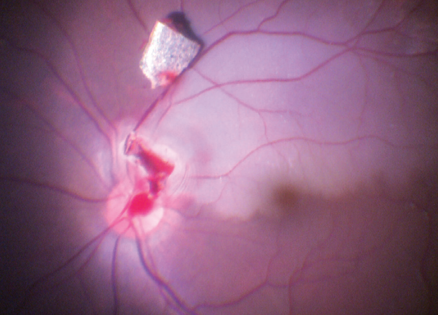 BRAO Caused by IOFB - Retina Today