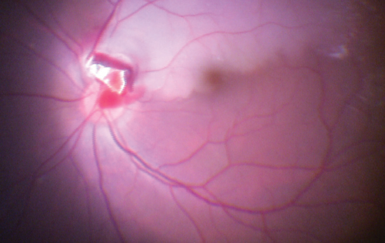 BRAO Caused by IOFB - Retina Today
