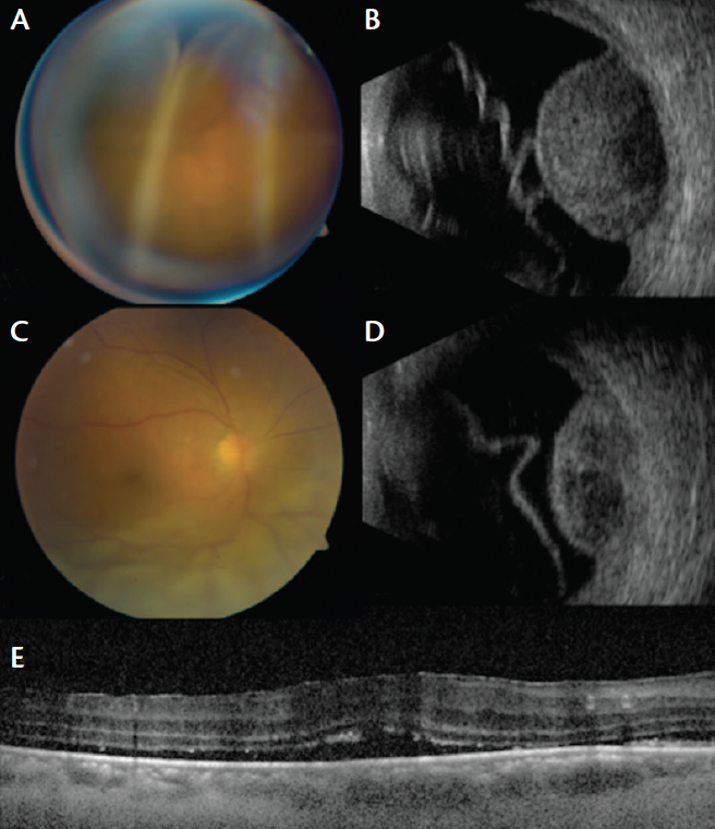 Prostate Carcinoma: Common in Men But Rare in the Eye - Retina Today
