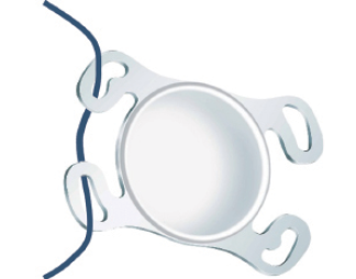 Four-point Fixation for Scleral-sutured IOLs - Retina Today