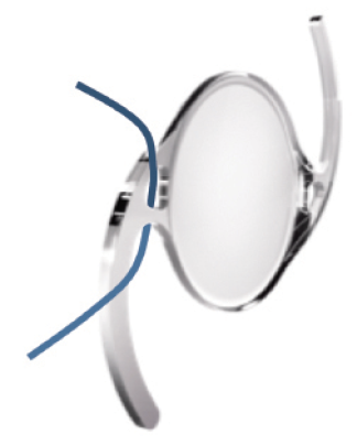 Four-point Fixation for Scleral-sutured IOLs - Retina Today