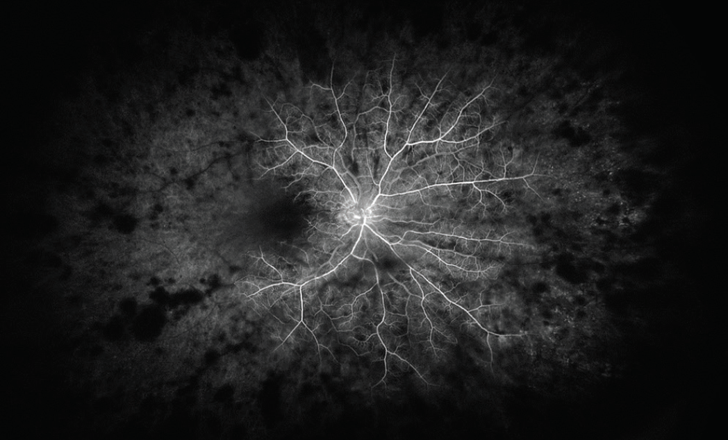 RVO Overview - Retina Today