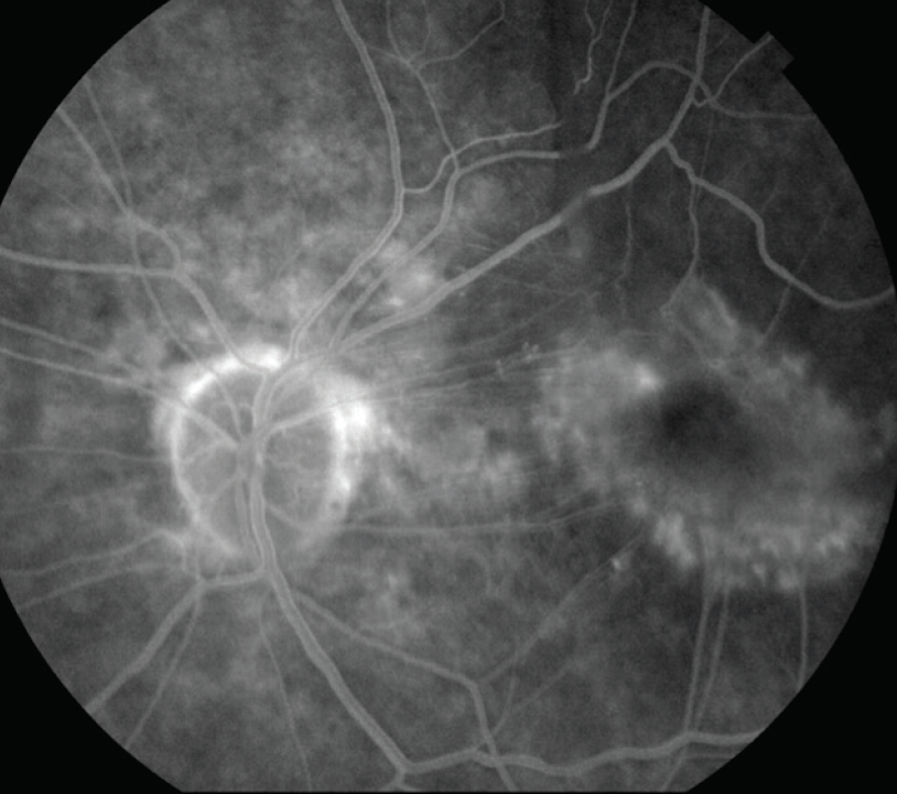 ERM With Good Vision: Should We Operate? - Retina Today