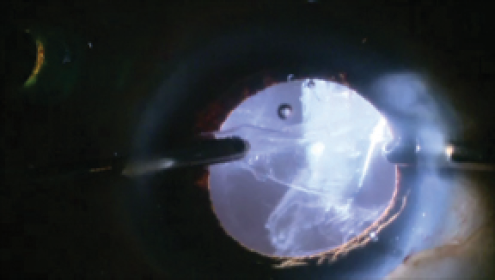 Chandelier-assisted Retroillumination for Combined Phacovitrectomy ...
