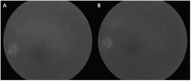 Recognizing Ocular Syphilis - Retina Today