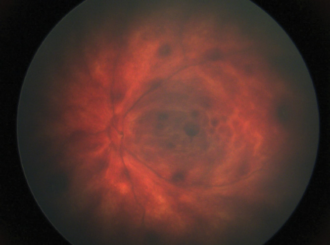Pediatric Trauma Requires an Individualized Approach - Retina Today
