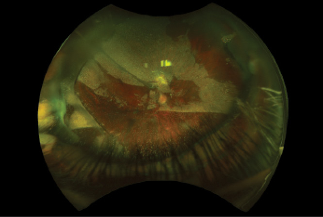 Top Five Pointers for Working With Silicone Oil - Retina Today
